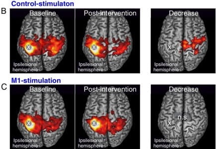 Adequately Targeted Brain Stimulation in Post-Stroke Motor ...
